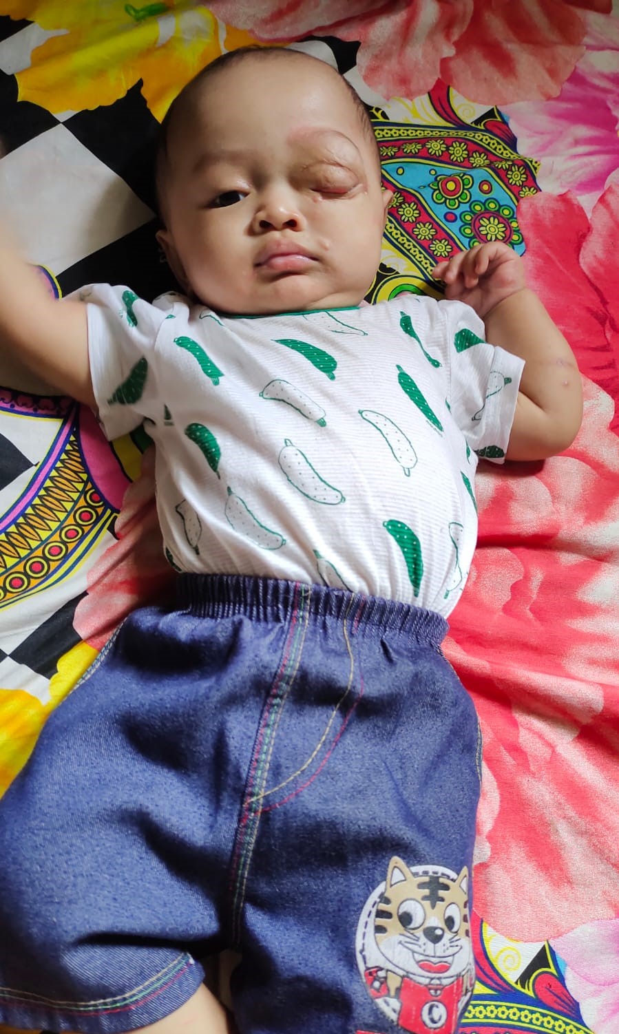 Benjolan Tumor Terus Membesar di Matanya, Bayi Ghafi Sangat Mengharapkan Bantuanmu!